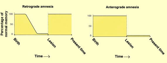 anterograde amnesia example