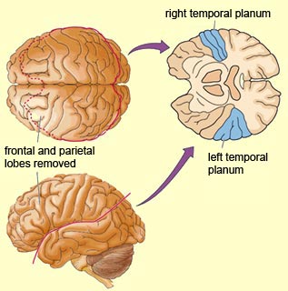 planum temporale wernicke